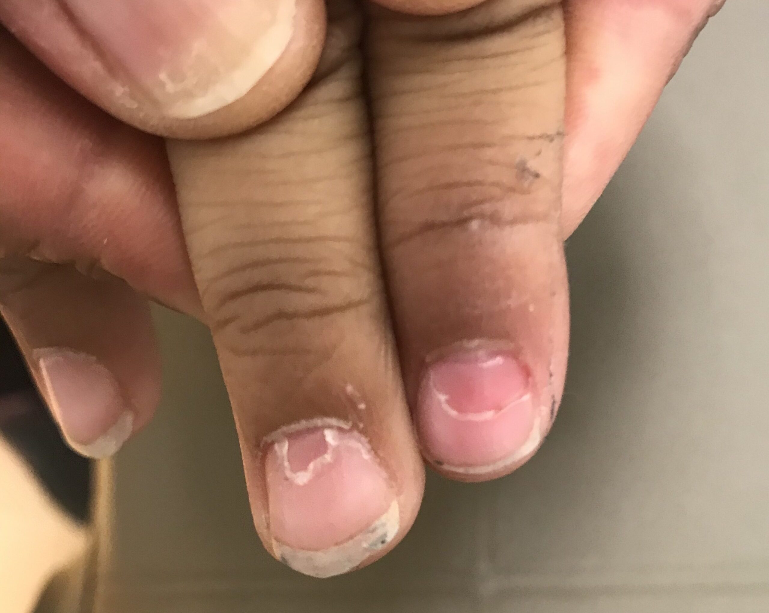 Discolored Nails - Signature Dermatology