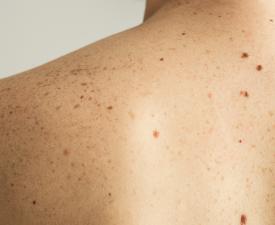 Inherited/Genetic Skin Conditions - Signature Dermatology