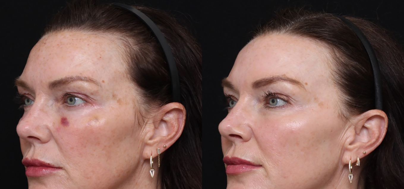 UltraClear Laser Resurfacing - Signature Dermatology