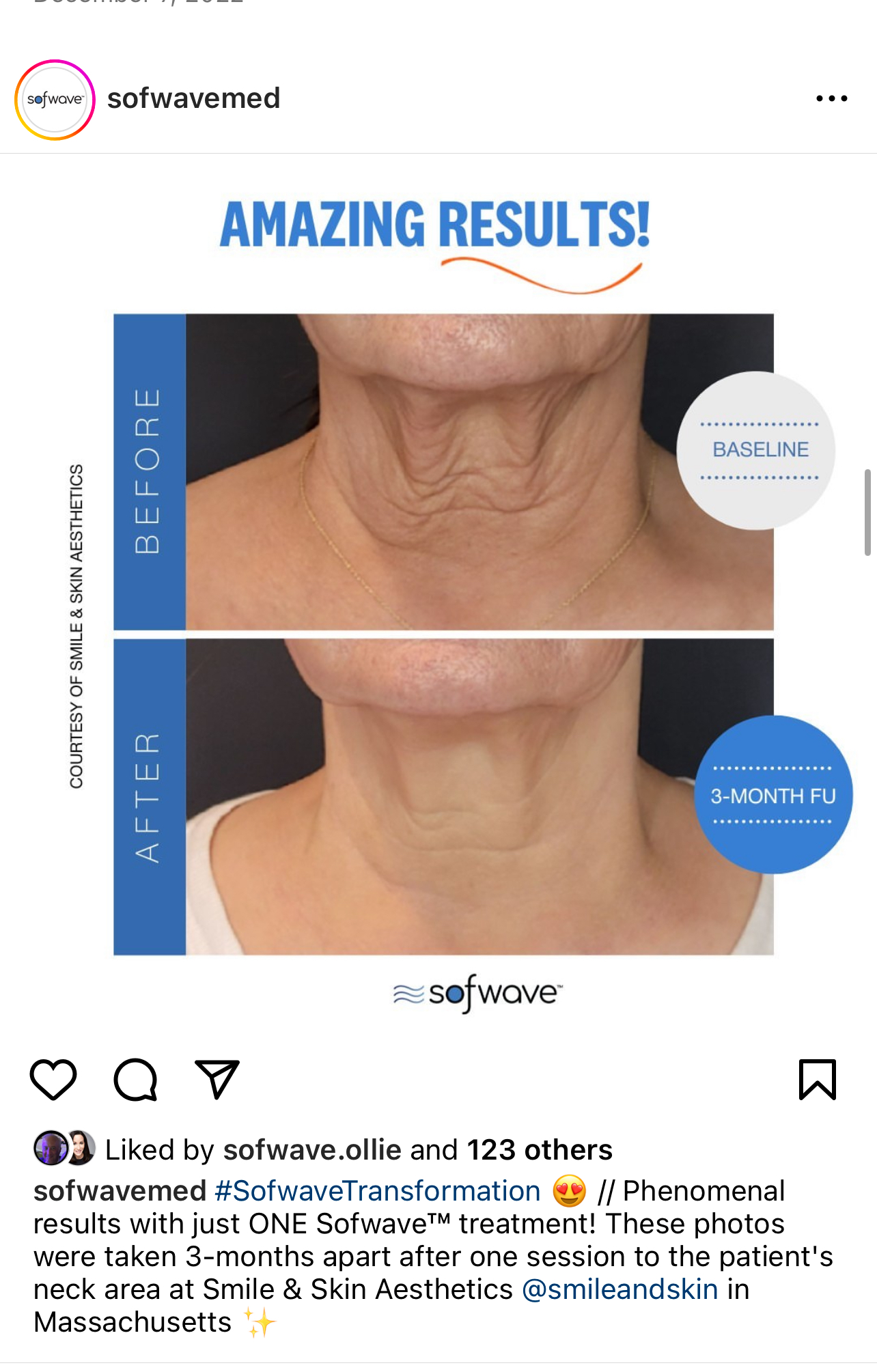 Sofwave - Signature Dermatology